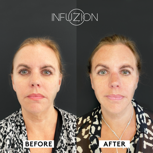 Infuzion System